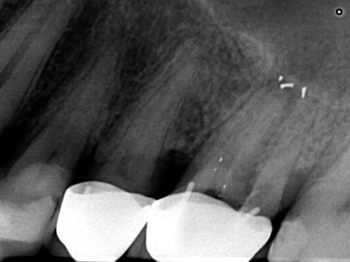 Dental News - Maxillary sinus and root canal therapy complications
